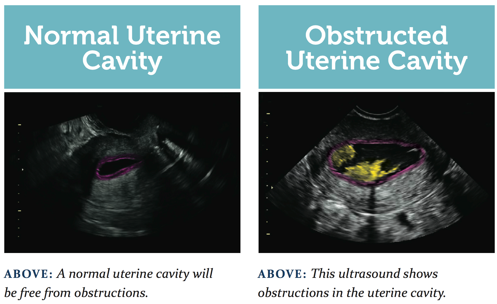Saline Sonohysterogram (SHG) - Fertility Testing: Vios Fertility Clinic